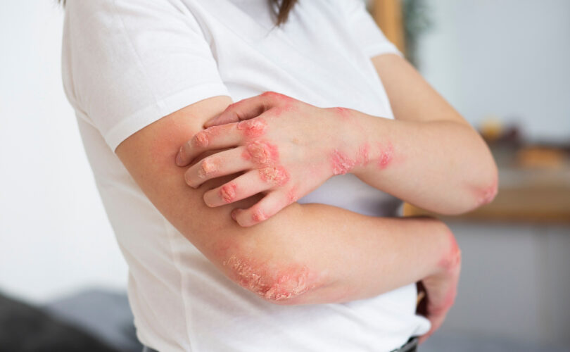 Pathogenèse du psoriasis : les racines du mal
