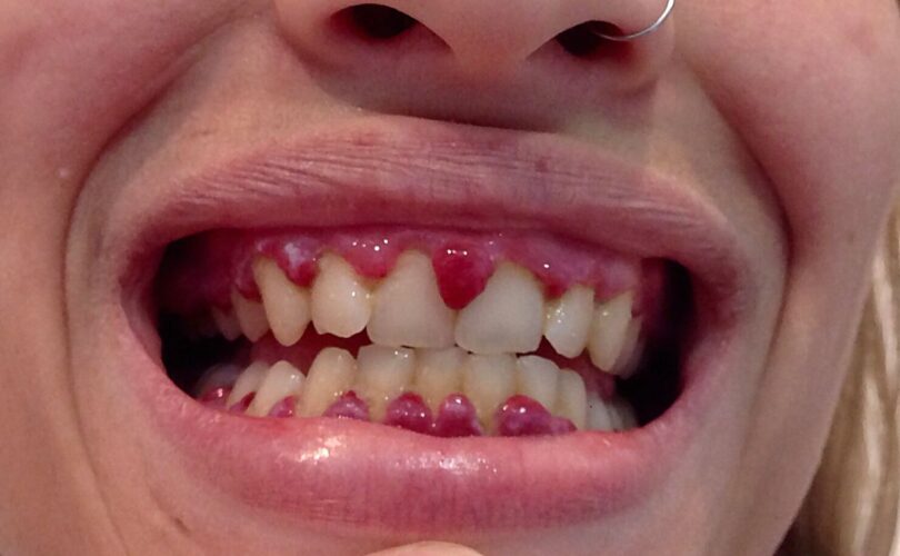 Régimes sans glucides III : Scorbut